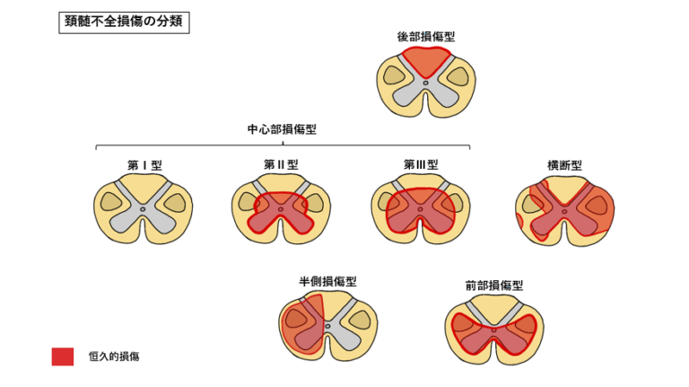 脊髄損傷⑥（脊髄損傷に影響する疾患） 交通事故コラム キリン先生の交通事故講座 だいち法律事務所